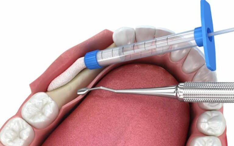 Bone and Gum Grafting Procedure and Benefits